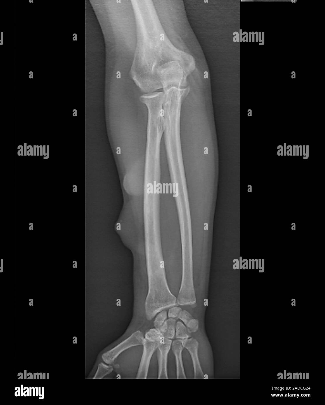 Subcutaneous lipomas on the arm. Frontal X-ray of the right forearm of ...