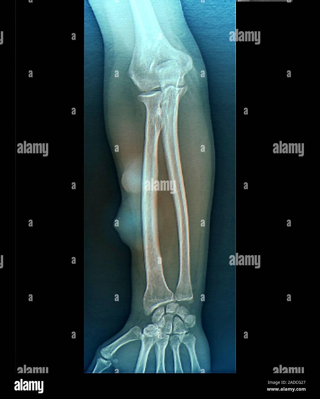 Subcutaneous lipomas on the arm. Coloured frontal X-ray of the right ...