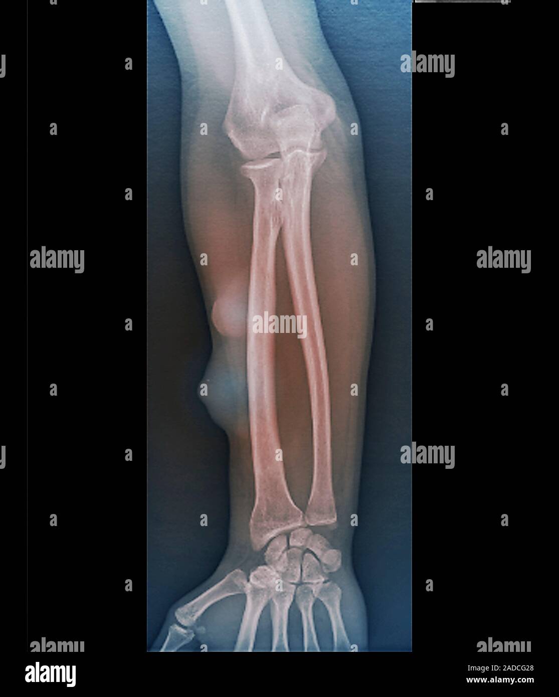 Subcutaneous lipomas on the arm. Coloured frontal X-ray of the right ...