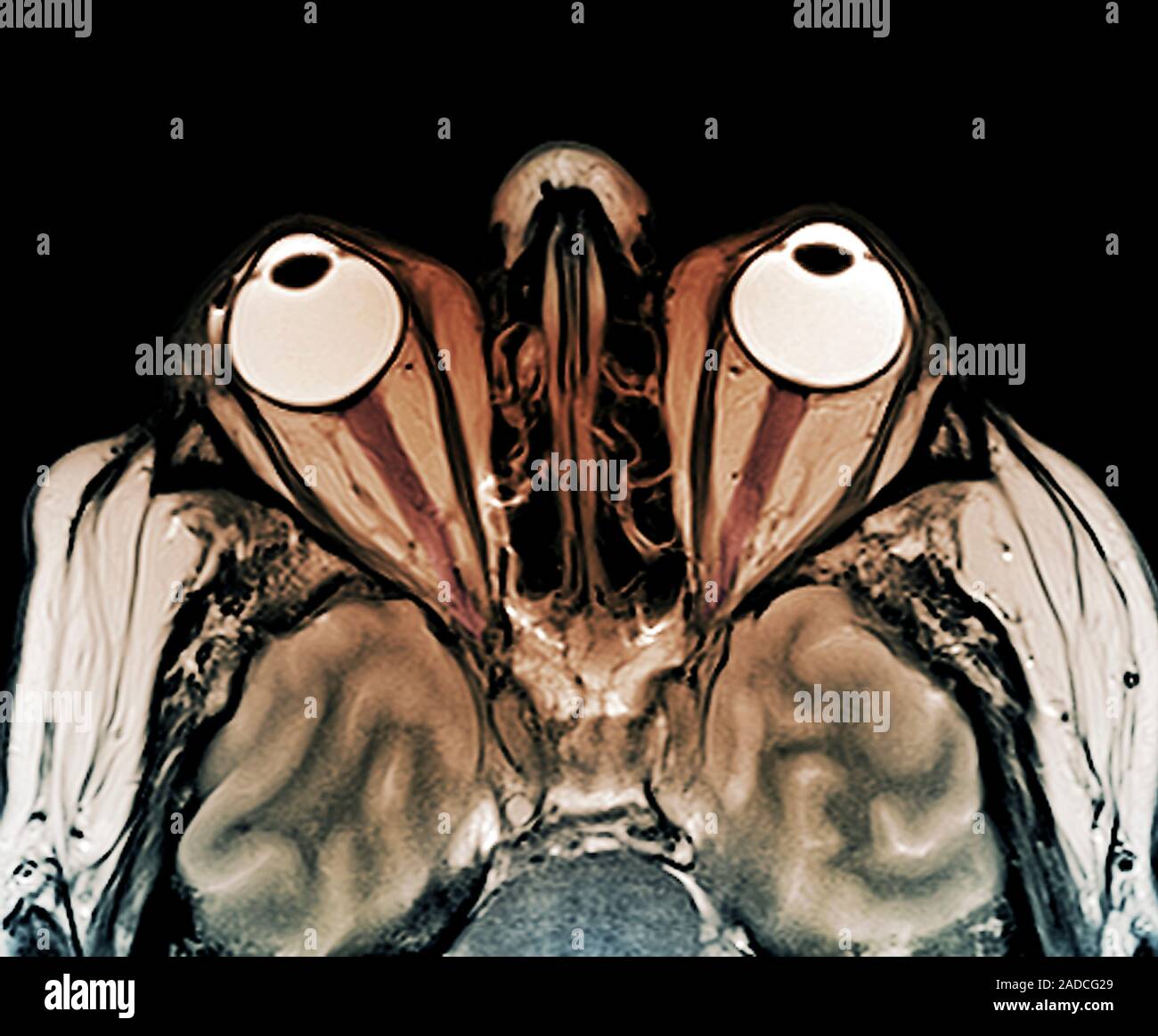 Human eyes and brain. Coloured axial magnetic resonance imaging (MRI ...