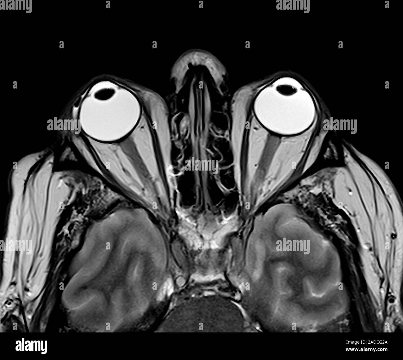Human eyes and brain. Axial magnetic resonance imaging (MRI) scan of ...