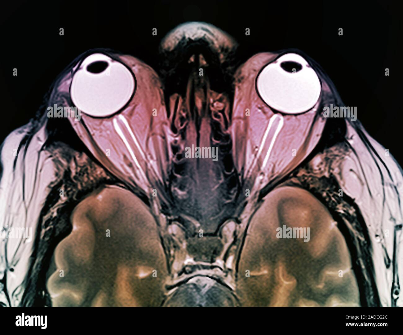 Human eyes and brain. Coloured axial magnetic resonance imaging (MRI ...