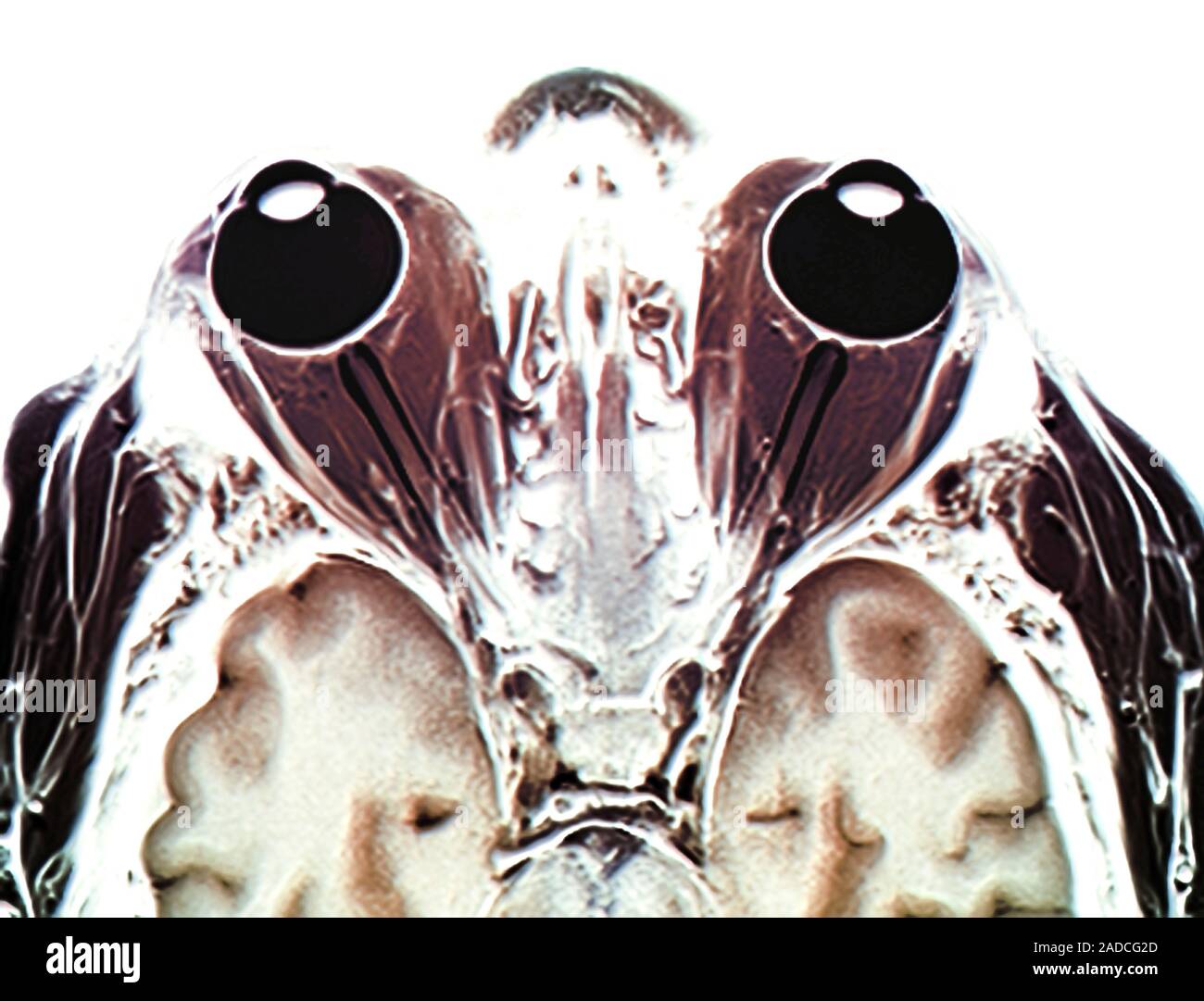 Human eyes and brain. Coloured axial magnetic resonance imaging (MRI ...