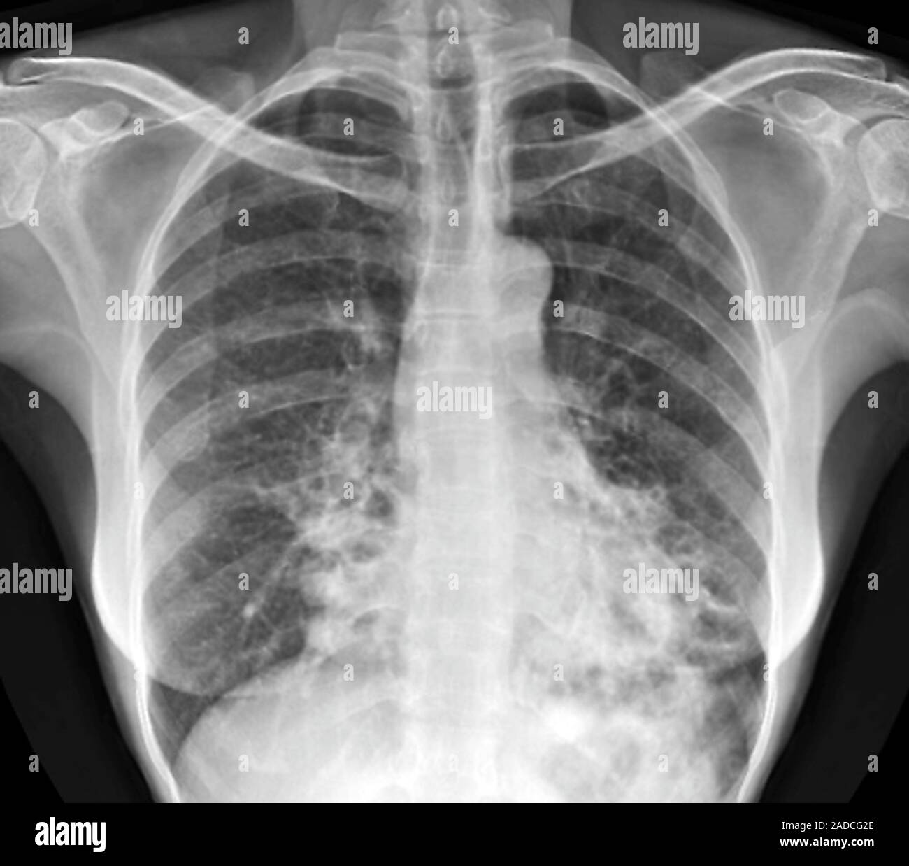 Bronchiectasis. Frontal X-ray of the chest of a 48-year-old woman who ...
