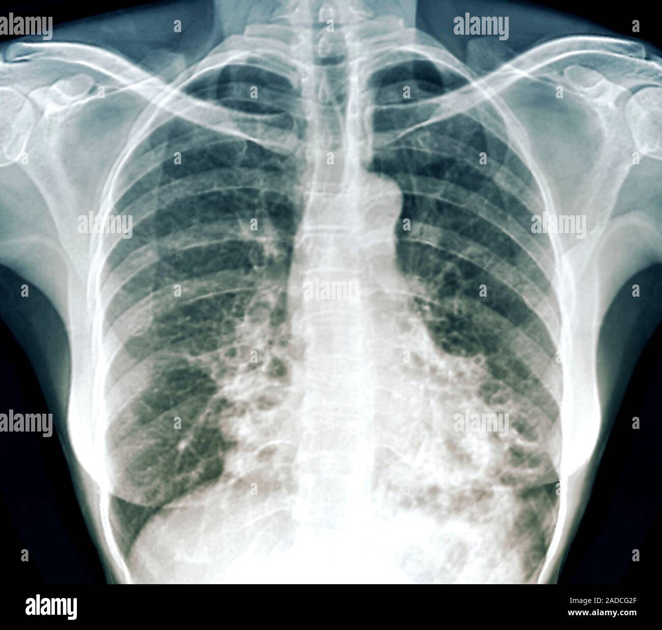 Bronchiectasis. Coloured frontal X-ray of the chest of a 48-year-old ...