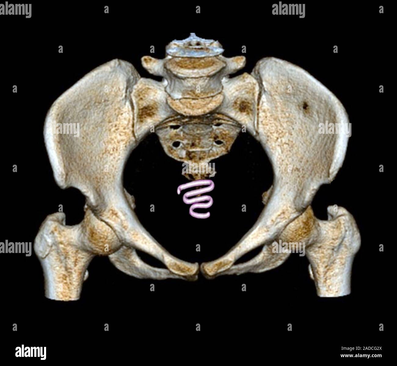 Intrauterine device in position. Coloured 3D frontal computed ...