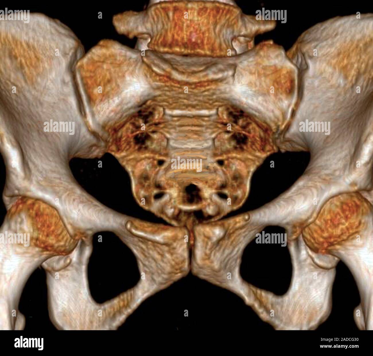 Front of pelvis and base of spine. Coloured 3D frontal computed ...
