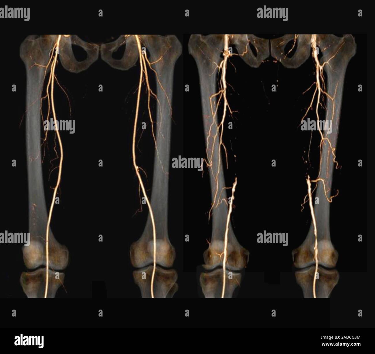 Effects of arteritis in the thigh. Coloured 3D frontal computed ...