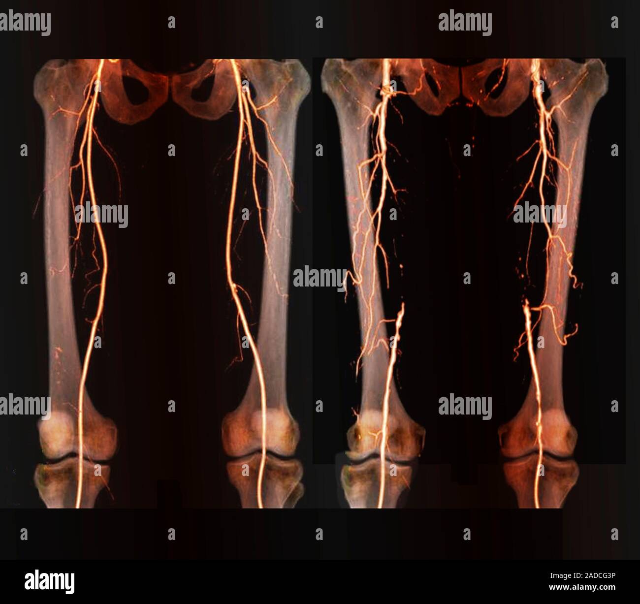 Effects of arteritis in the thigh. Coloured 3D frontal computed ...