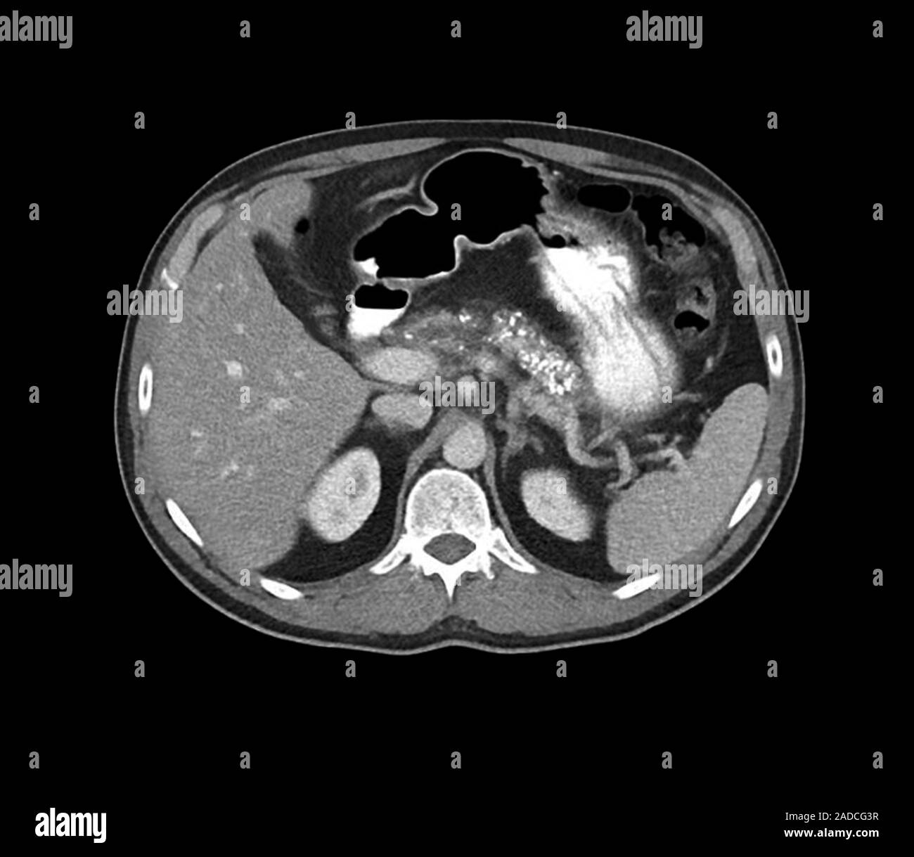 Pancreatitis. Axial computed tomography (CT) scan through the abdomen ...