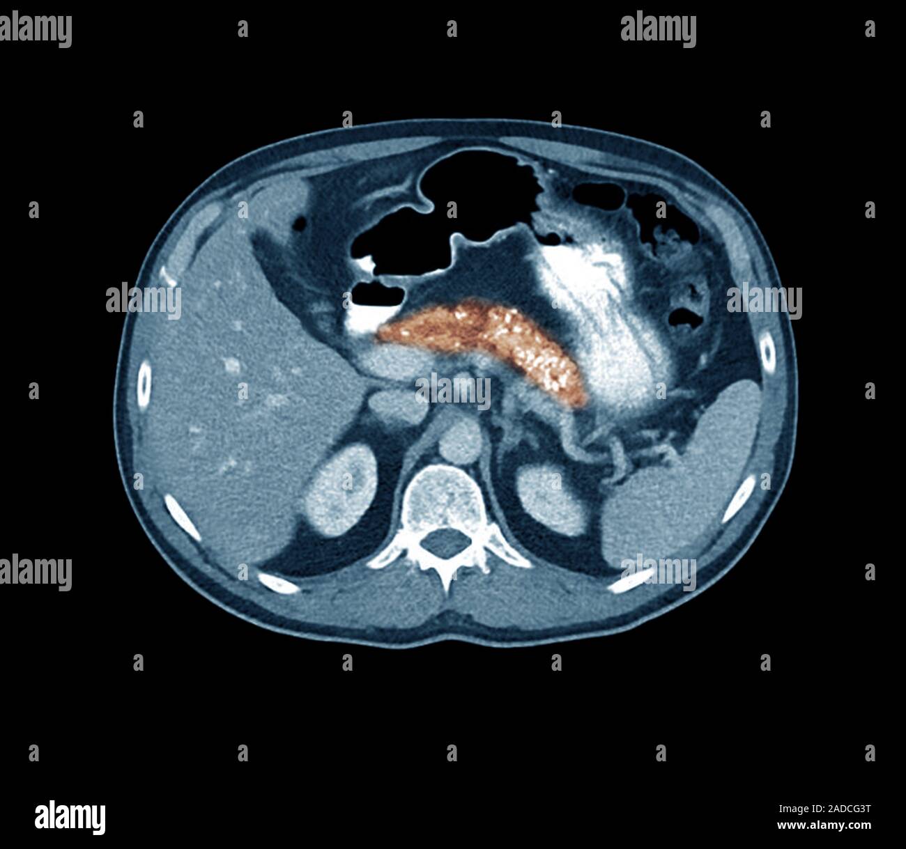 Pancreatitis. Coloured axial computed tomography (CT) scan through the ...