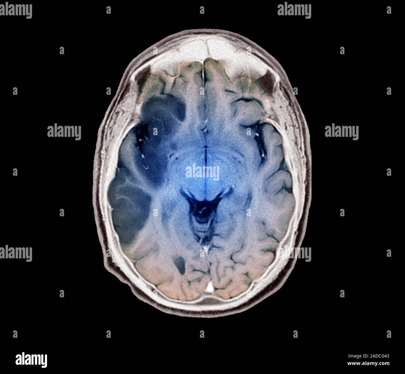 Stroke. Coloured axial magnetic resonance imaging (MRI) scan through ...