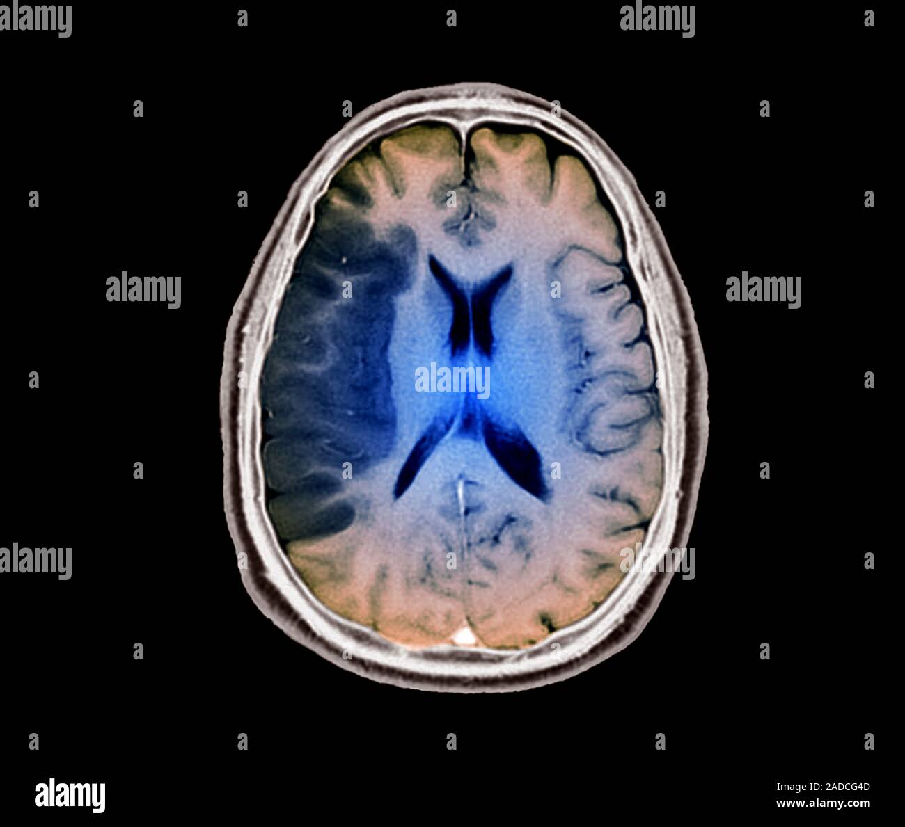Stroke. Coloured axial magnetic resonance imaging (MRI) scan through the brain of a 54-year-old ...
