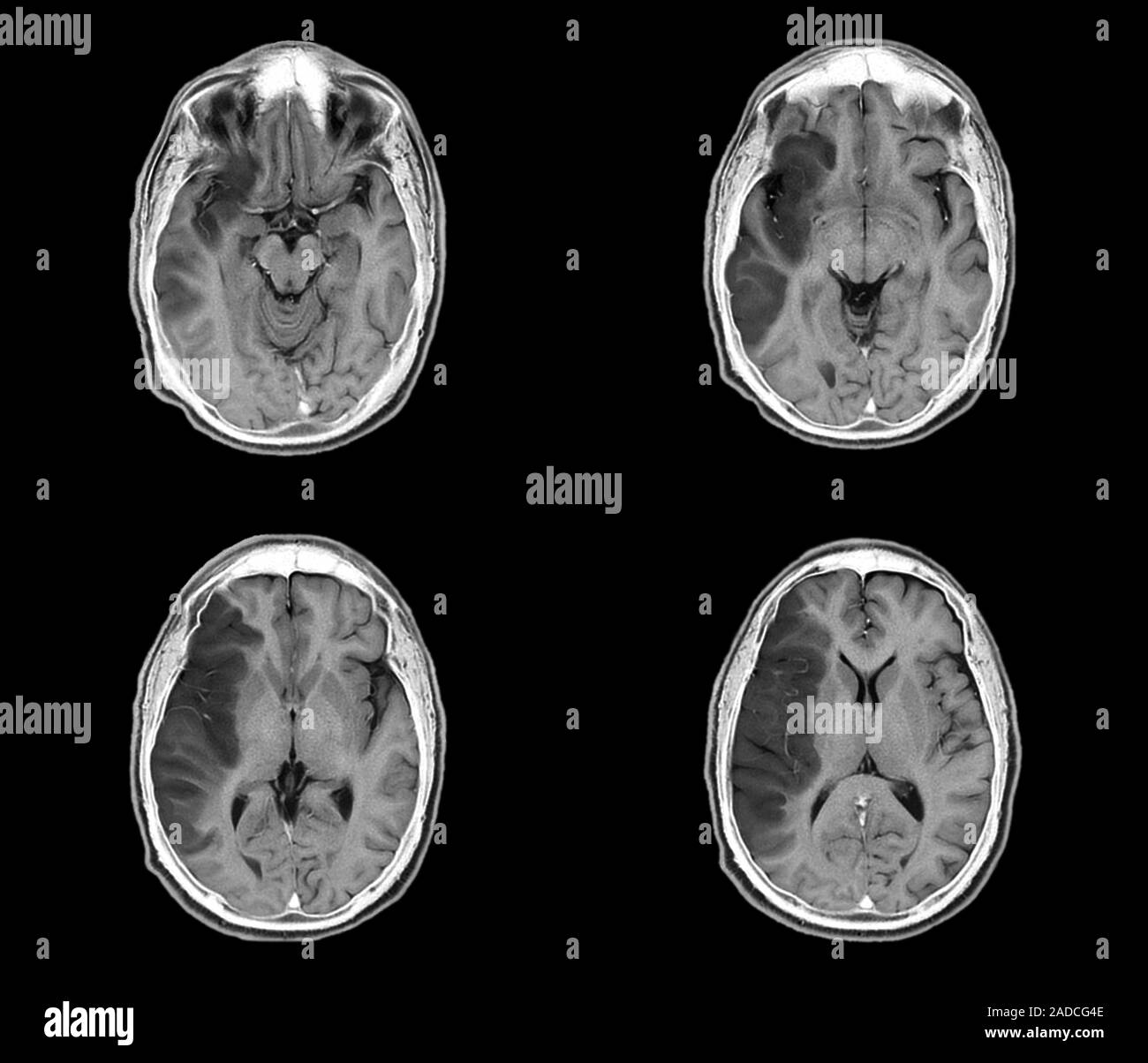 Stroke. Axial magnetic resonance imaging (MRI) scans through the brain ...