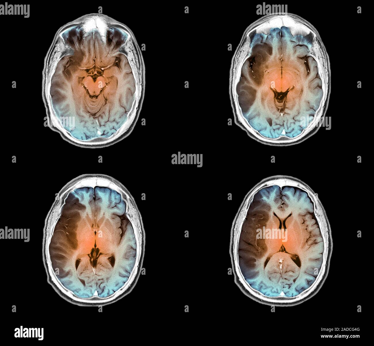 Stroke. Coloured axial magnetic resonance imaging (MRI) scans through ...