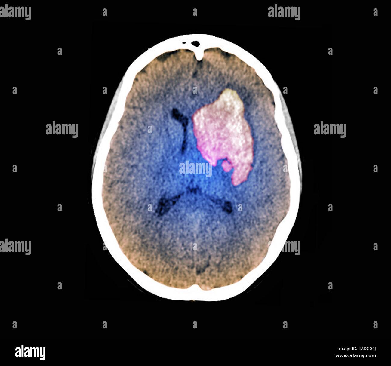 Intracerebral haemorrhage. Coloured axial computed tomography (CT) scan through the brain of a ...