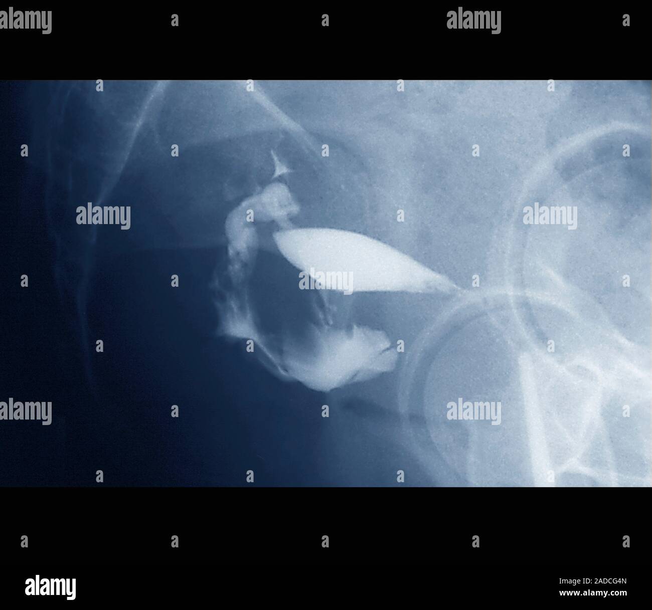 Retroverted uterus. Coloured hystero-salpingogram (contrast medium X ...