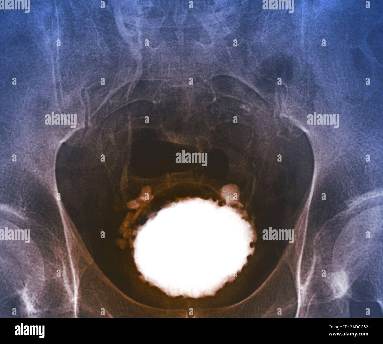 Neurogenic bladder. Coloured frontal X-ray using intravenous urography ...