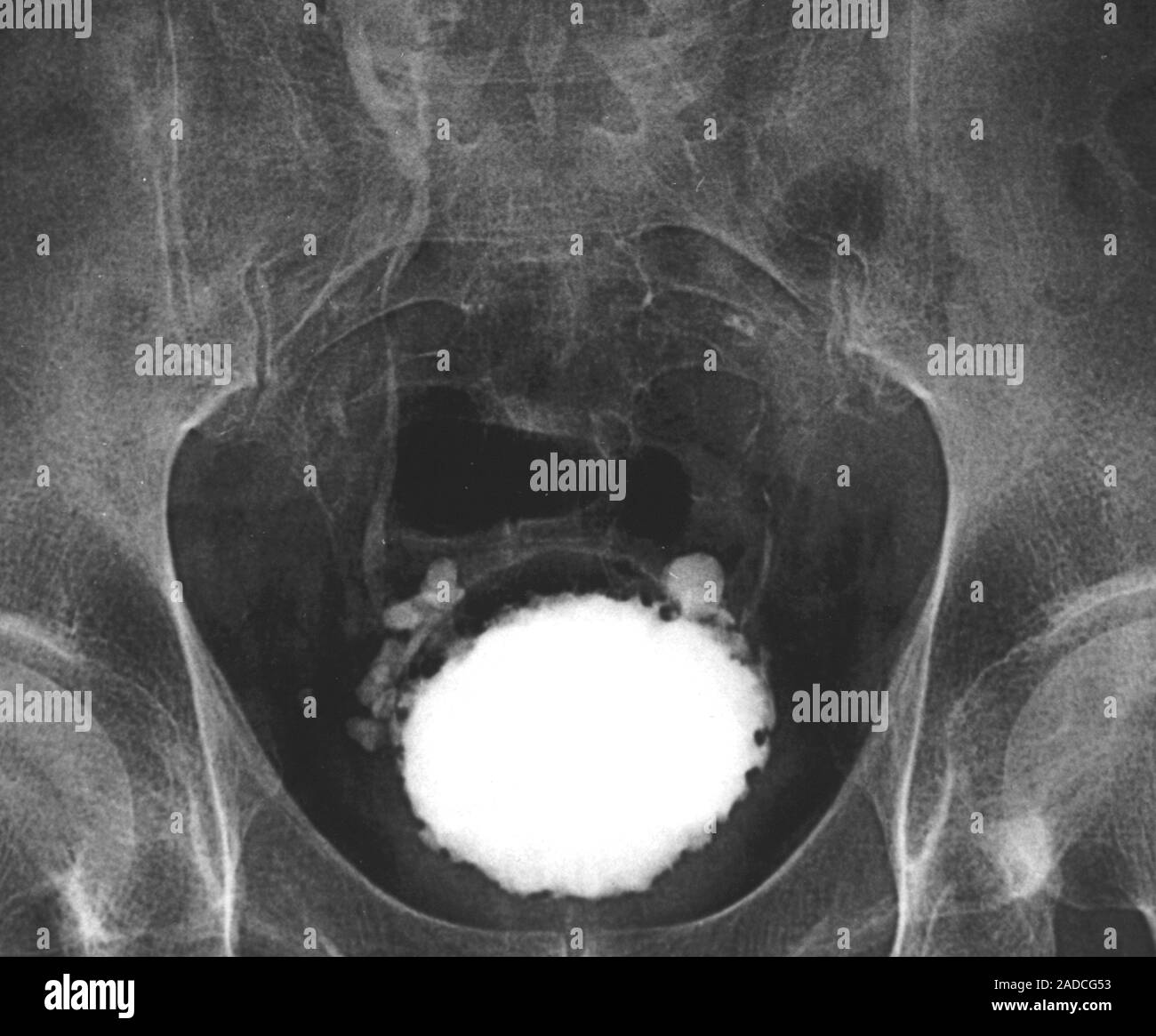 Neurogenic bladder. Frontal X-ray using intravenous urography (injected ...