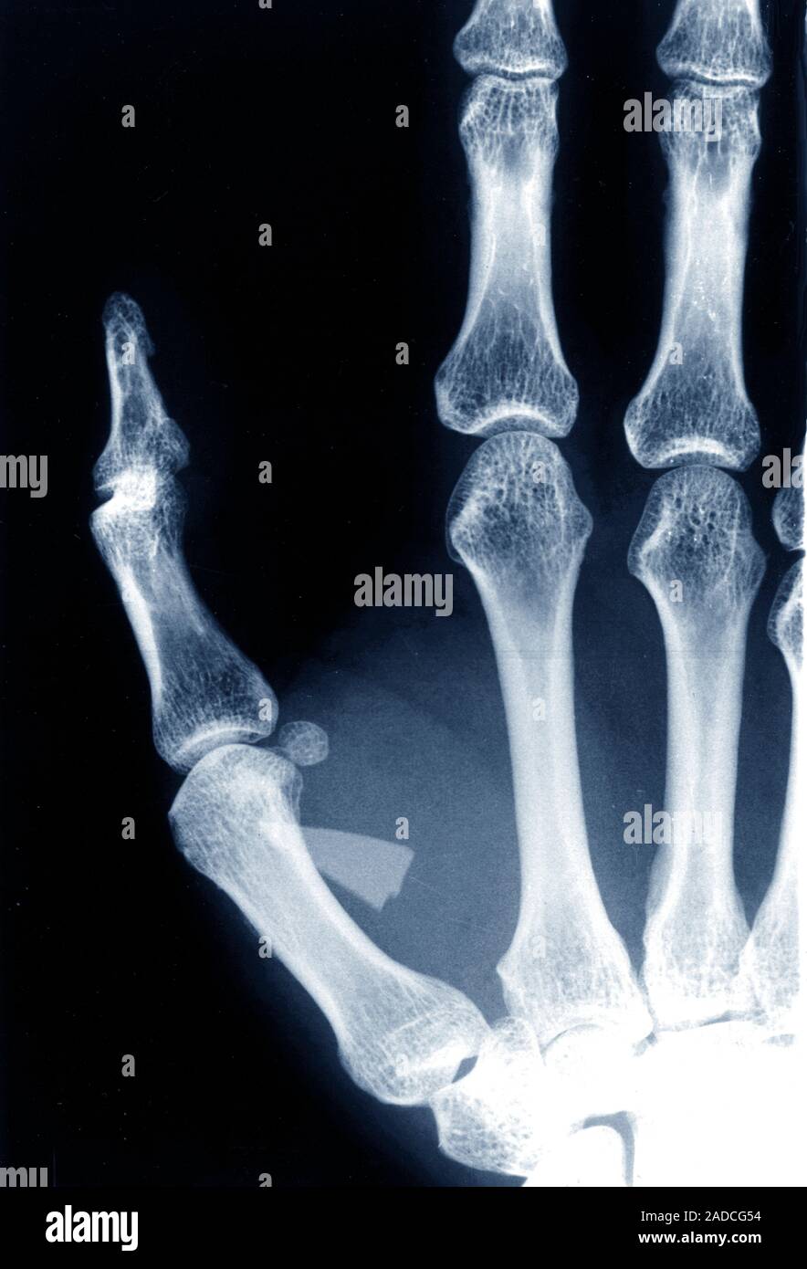 Glass shard in thumb. Frontal X-ray of a patient's right thumb, with a ...