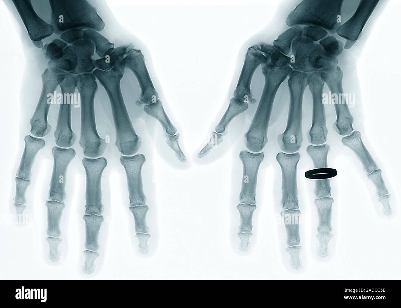 Osteoarthritis of the thumb. Frontal bilateral X-rays of the hands of a ...