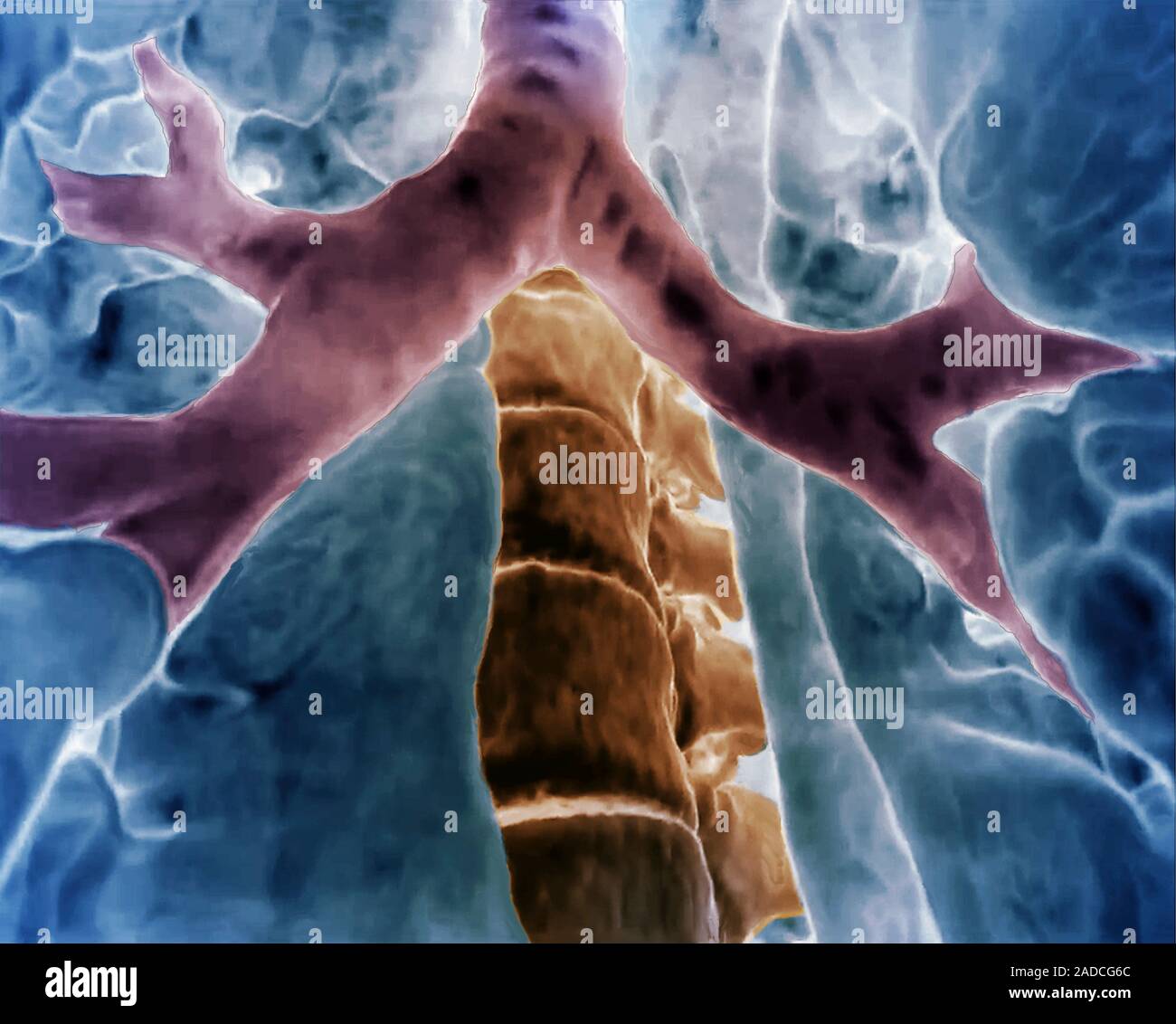 Bronchial divisions. Coloured 3D computed tomography (CT) scan of the ...