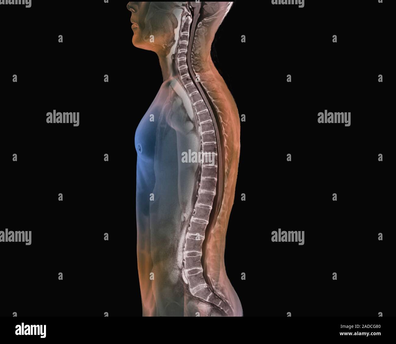 Backbone and spinal cord. Sagittal magnetic resonance imaging (MRI ...