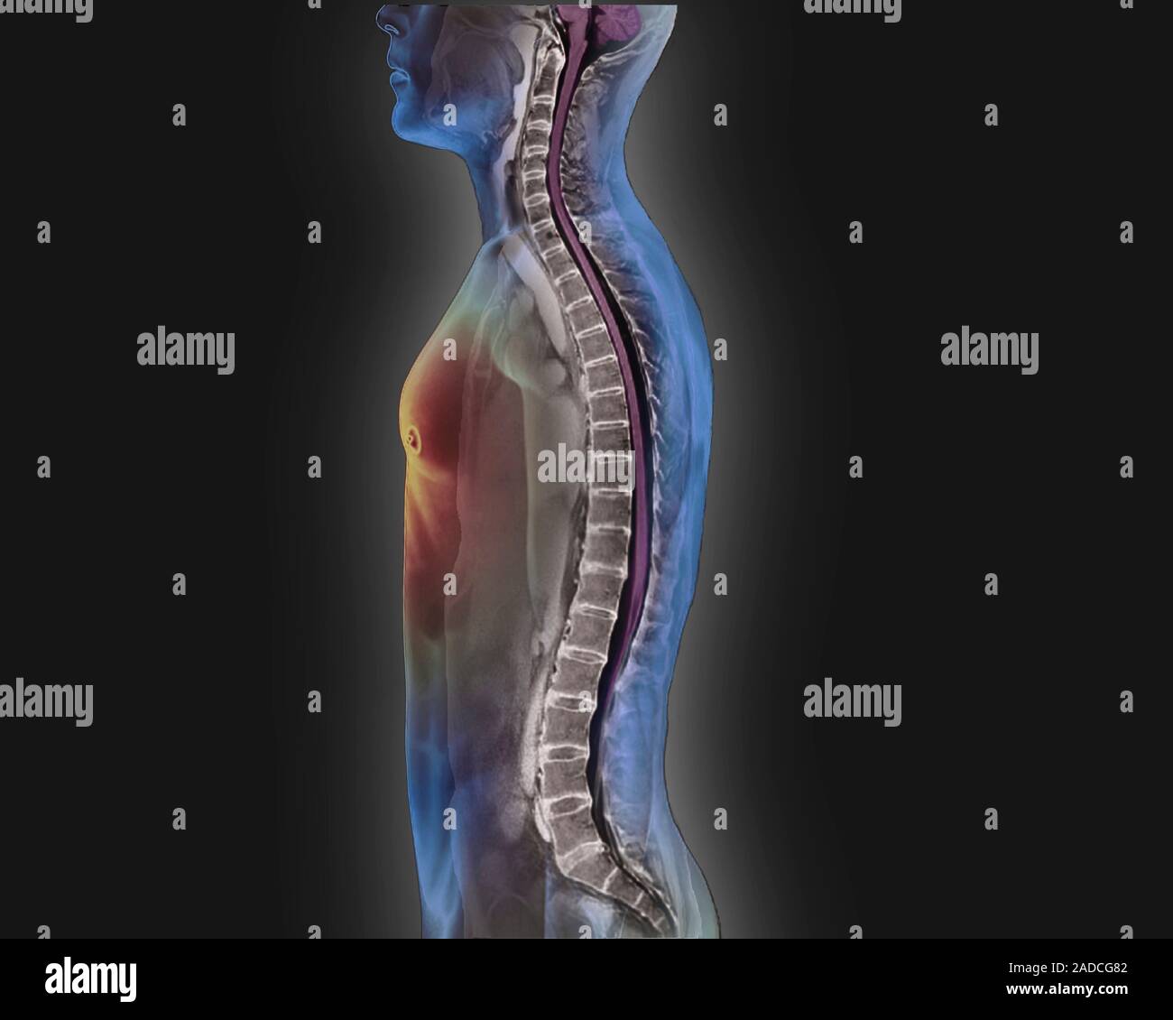 Backbone and spinal cord. Sagittal magnetic resonance imaging (MRI ...