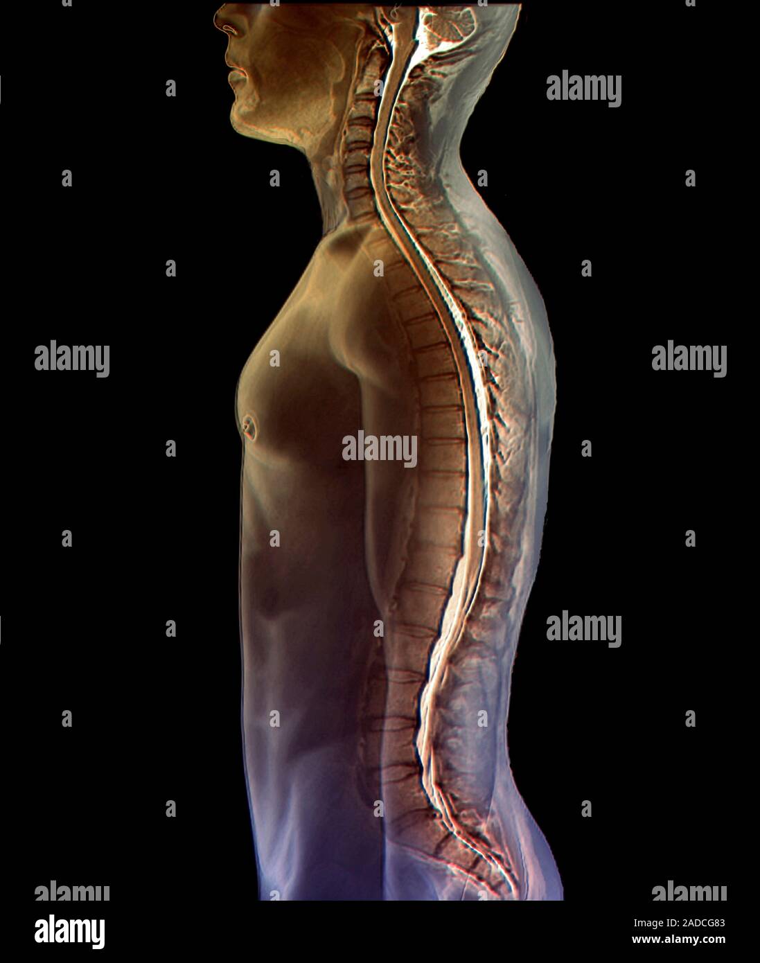 Backbone and spinal cord. Sagittal magnetic resonance imaging (MRI ...