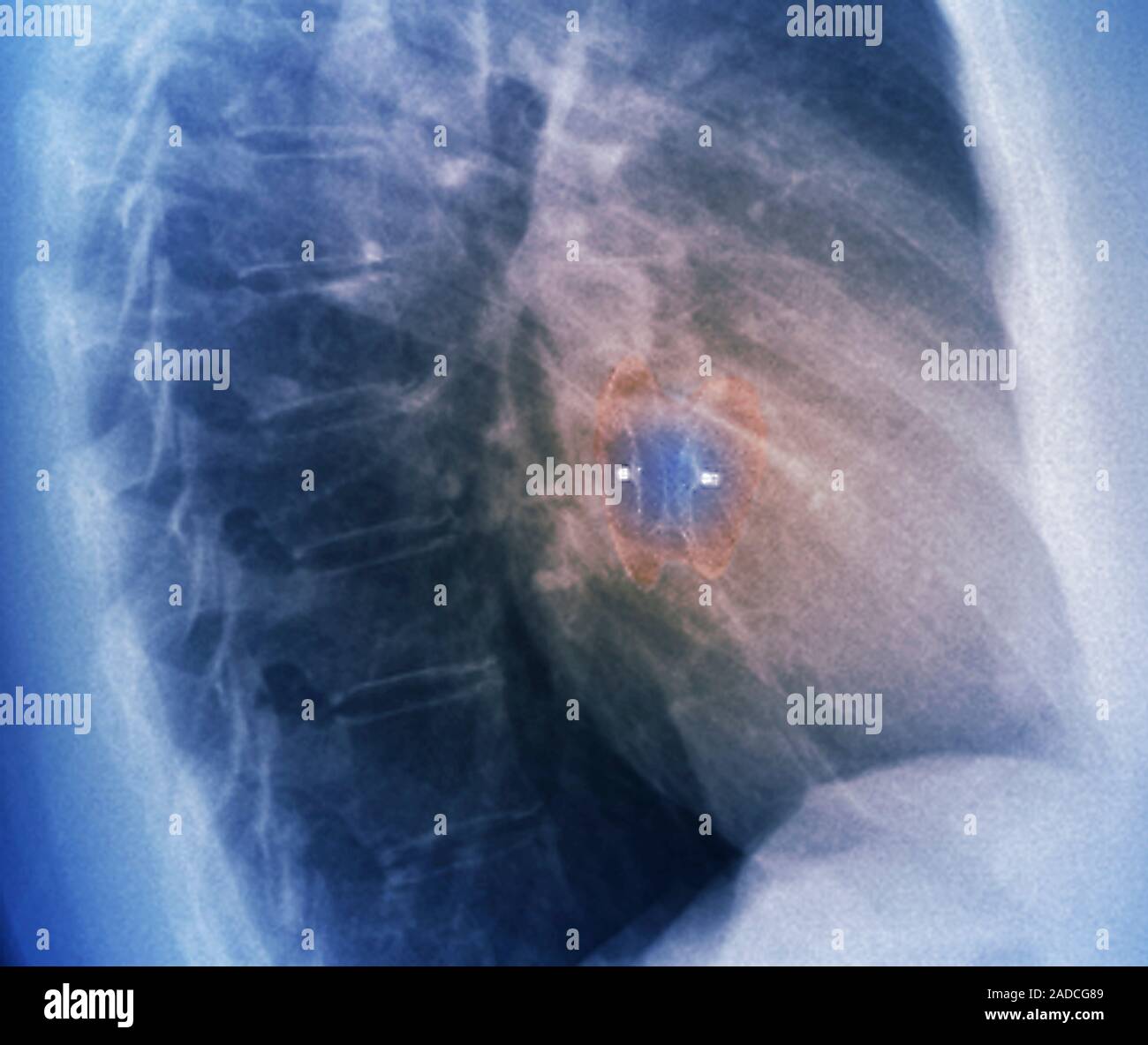 Heart defect implant. Coloured lateral (side view) X-ray of the chest ...