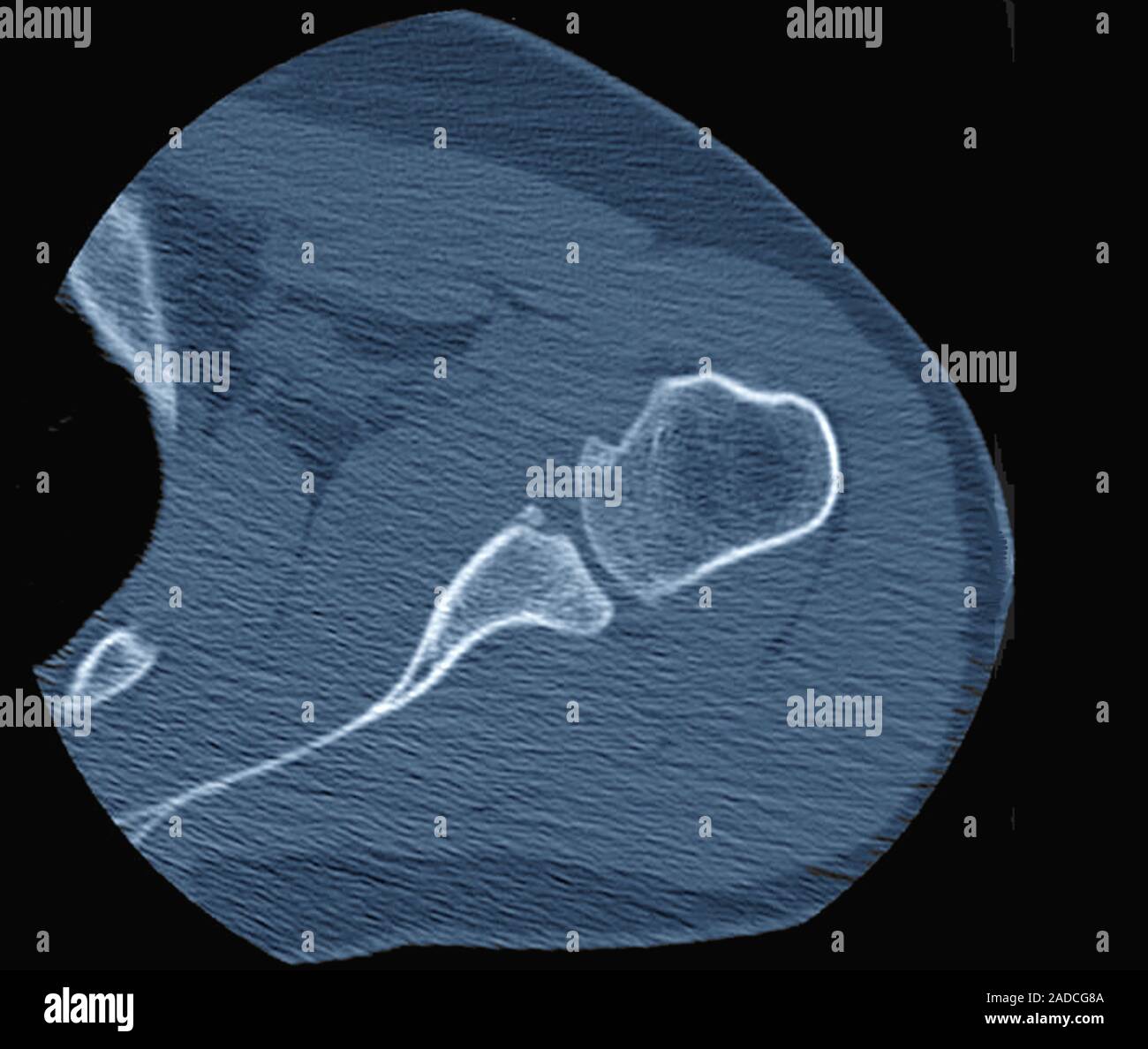 Shoulder joint lesion. Axial computed tomography (CT) scan of the ...