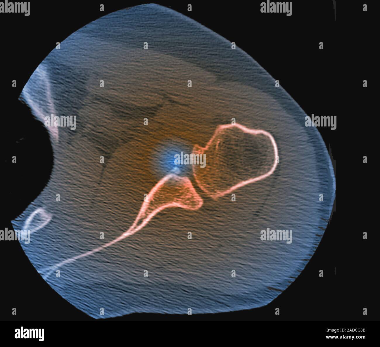 Shoulder joint lesion. Coloured axial computed tomography (CT) scan of ...