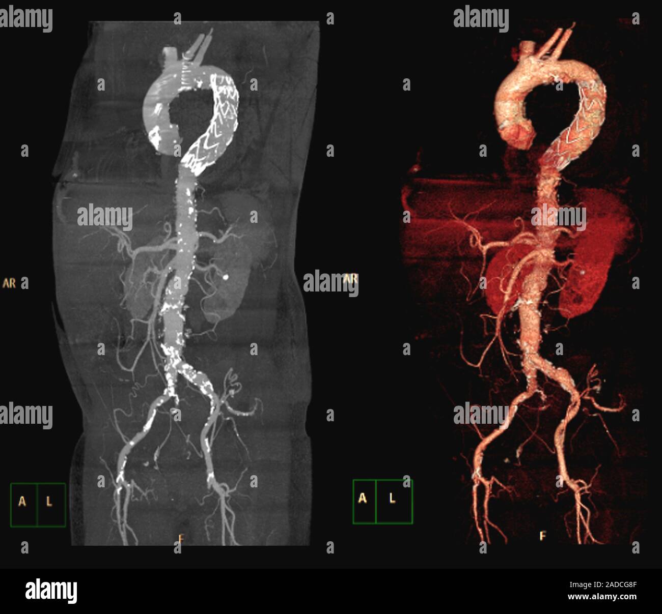 Stent in aortic aneurysm. Coloured computed tomography (CT) angiograms ...