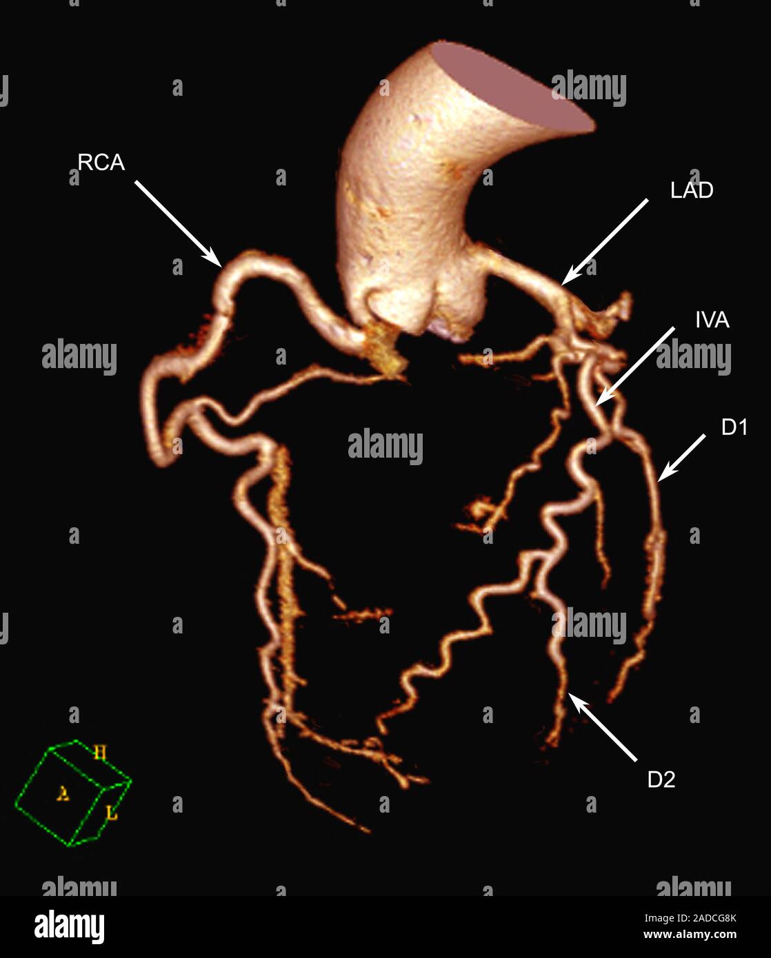 Coronary artery evaluation. Coloured 3D computed tomography (CT) angiography scan of the ...