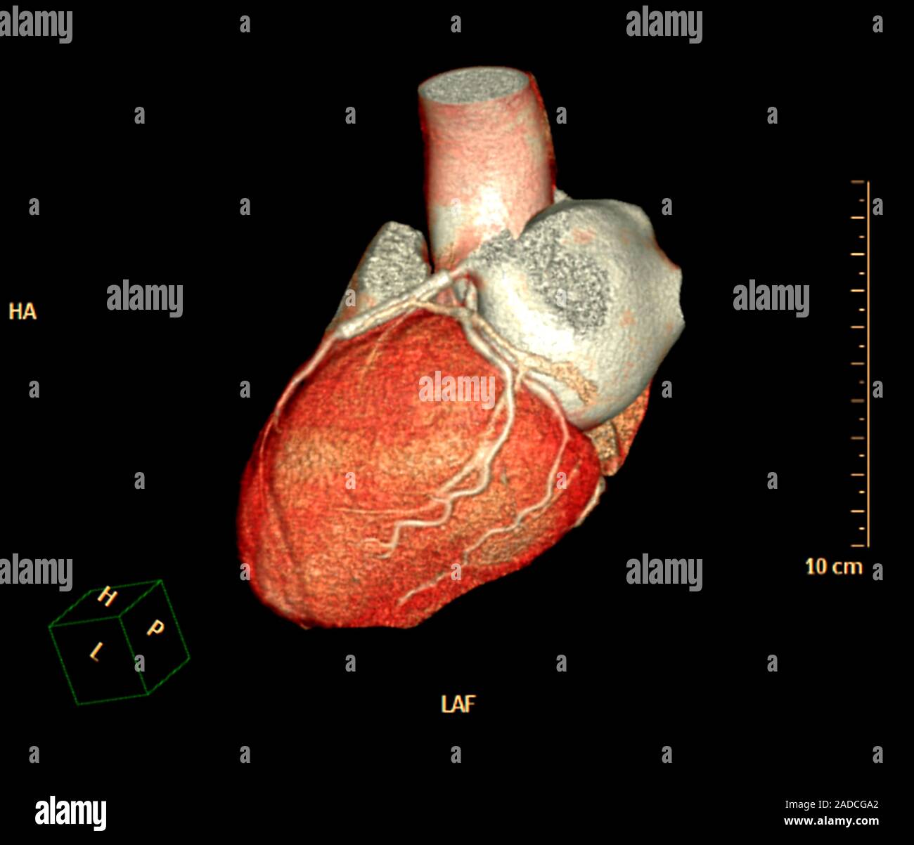 Coronary artery stent evaluation. Coloured 3D computed tomography (CT ...