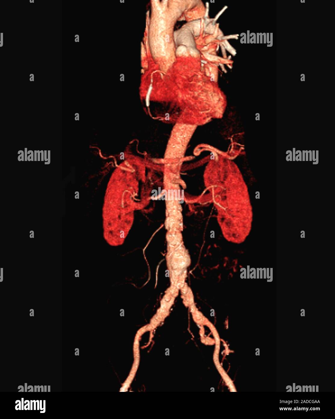 Cholesterol embolism. Coloured 3D computed tomography (CT) angiogram of ...