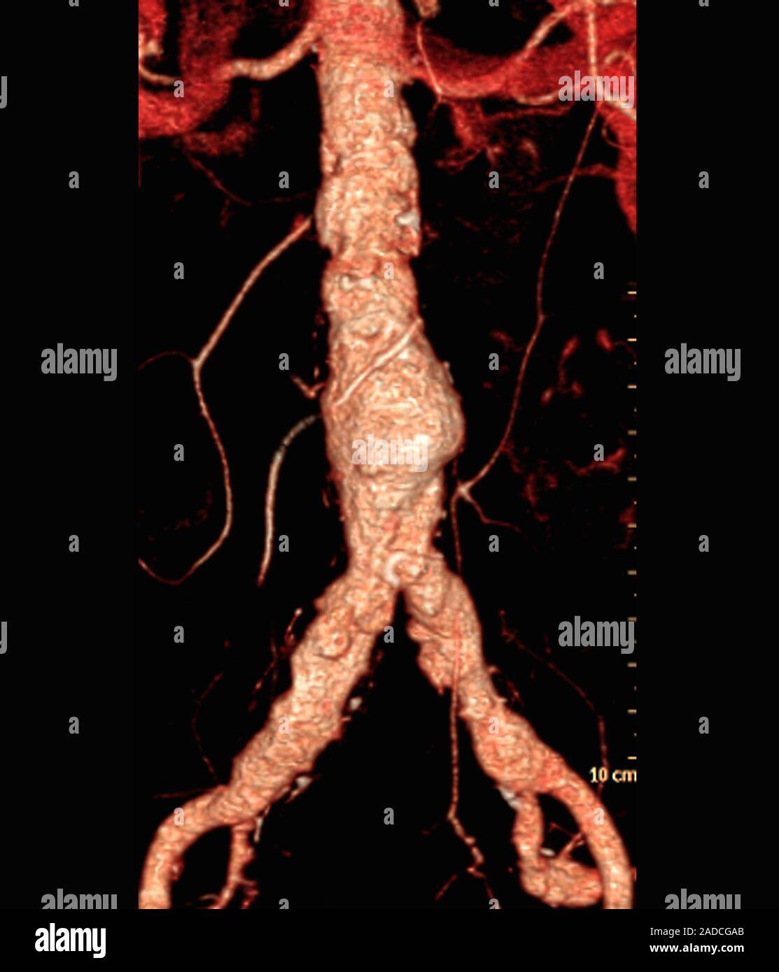 Cholesterol embolism. Coloured 3D computed tomography (CT) angiogram of ...