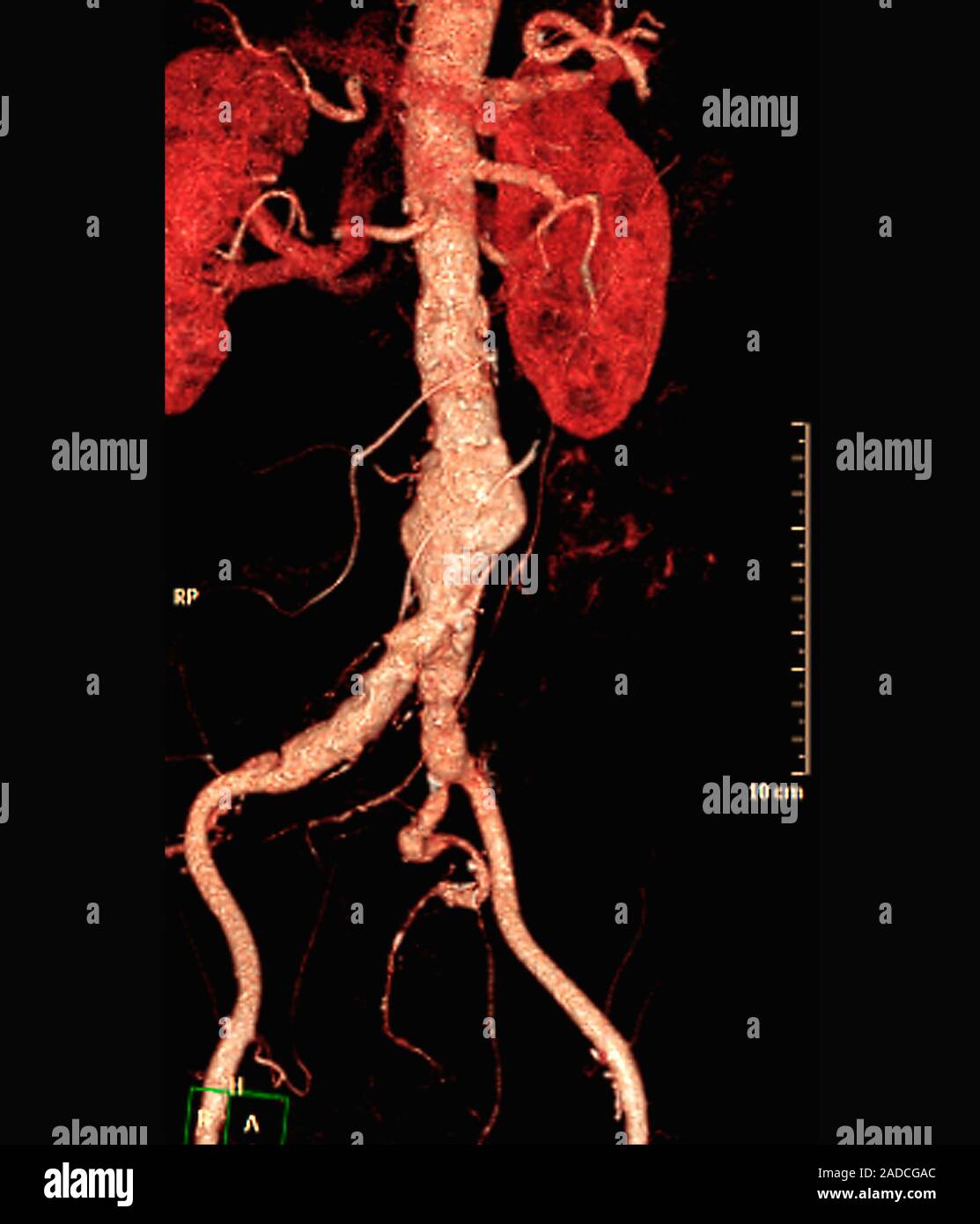 Cholesterol embolism. Coloured 3D computed tomography (CT) angiogram of ...