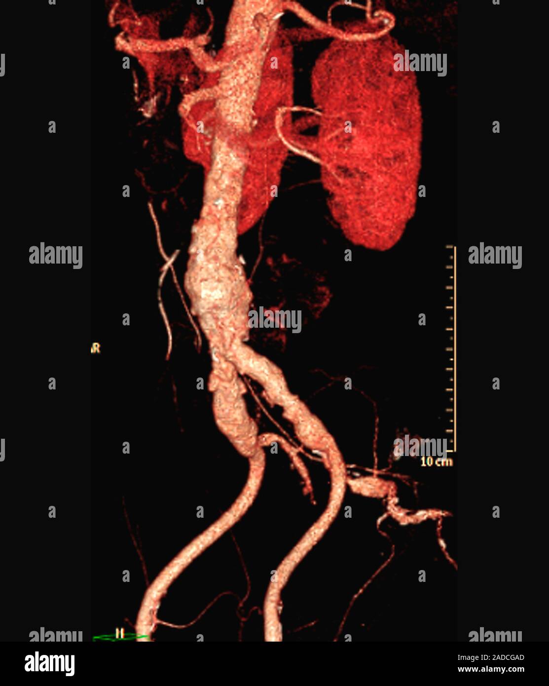 Cholesterol embolism. Coloured 3D computed tomography (CT) angiogram of ...