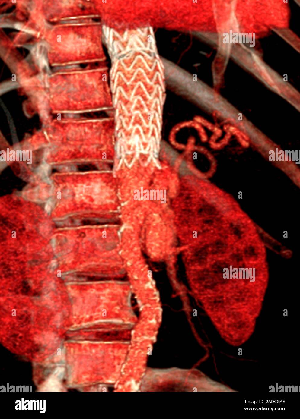 Stent in aortic dissection. Coloured 3D computed tomography (CT ...