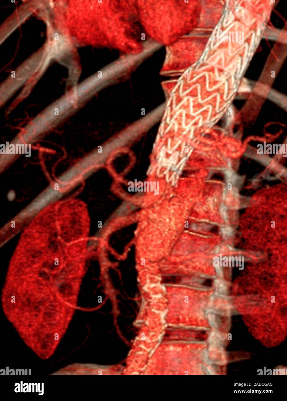 Stent in aortic dissection. Coloured 3D computed tomography (CT ...