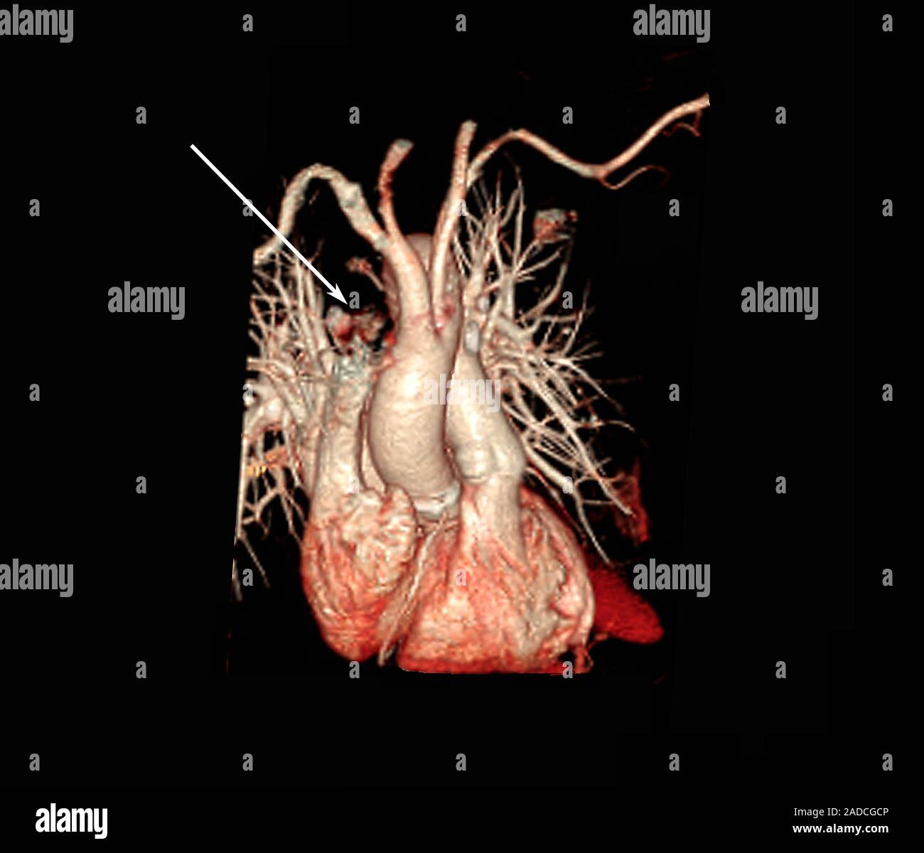 Pulmonary embolism. Coloured 3D computed tomography (CT) angiography scan of the heart and ...