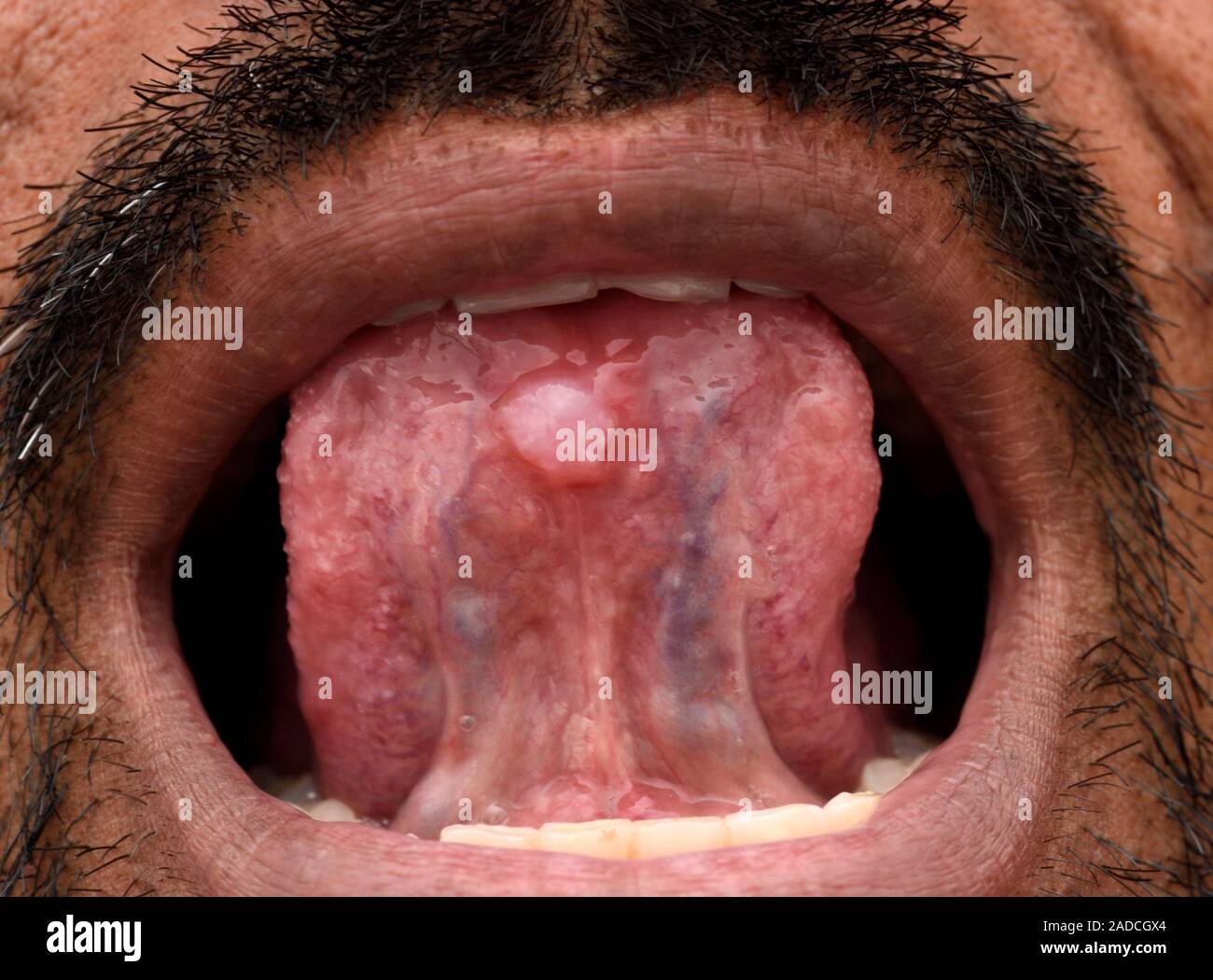 Not for use in Television Not for use in Television Mucous retention ...