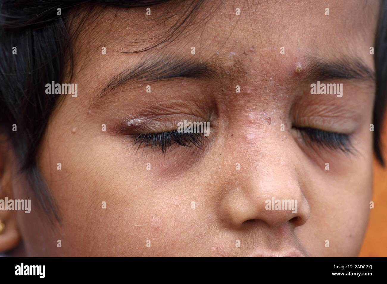 Not for use in Television Not for use in Television Periporitis ...