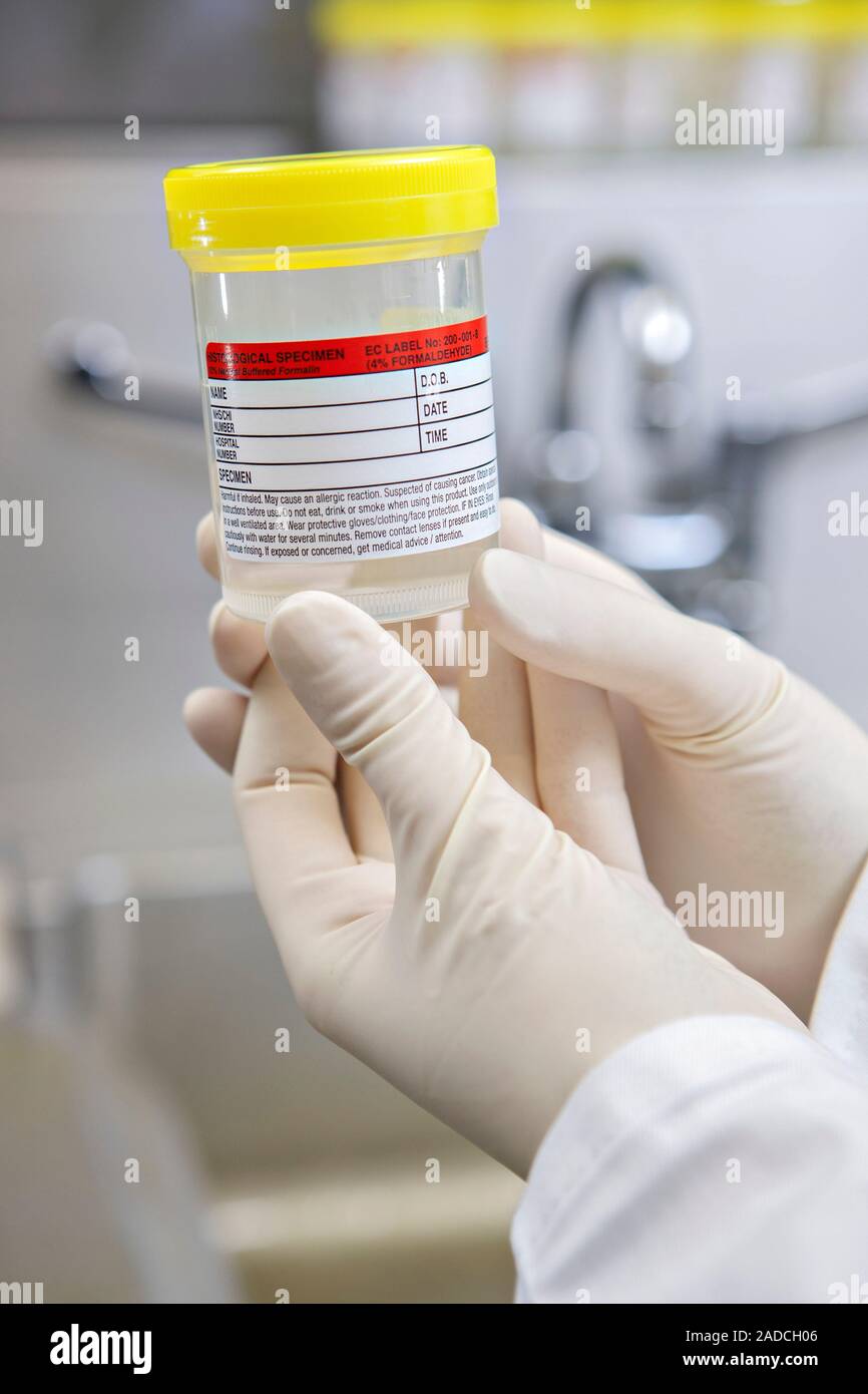 Autopsy room. Mortuary worker holding an autopsy specimen jar Stock ...