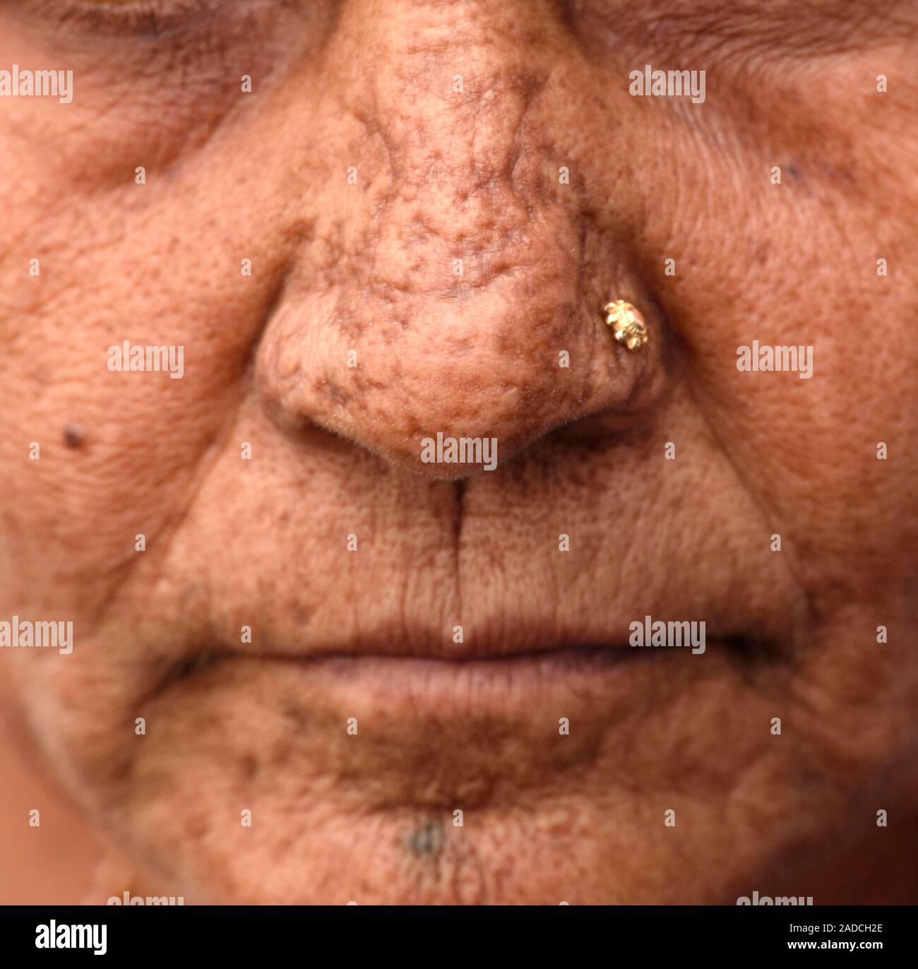 Not for use in Television Not for use in Television Smallpox scarring ...