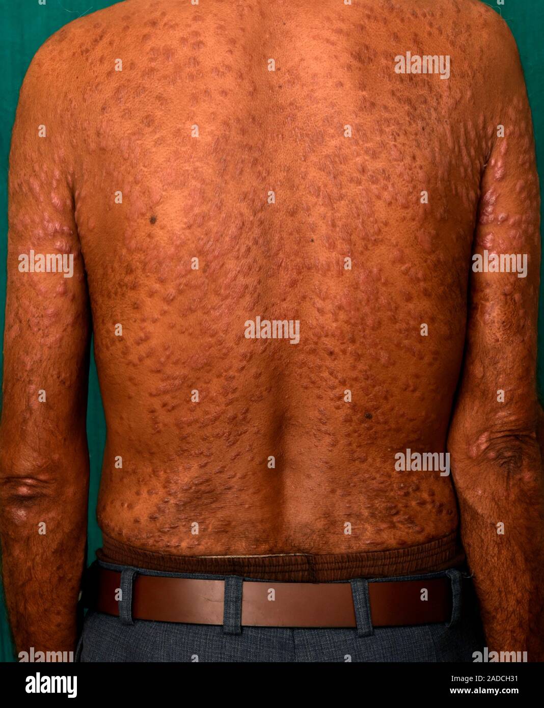 Not for use in Television Not for use in Television Diffuse cutaneous ...