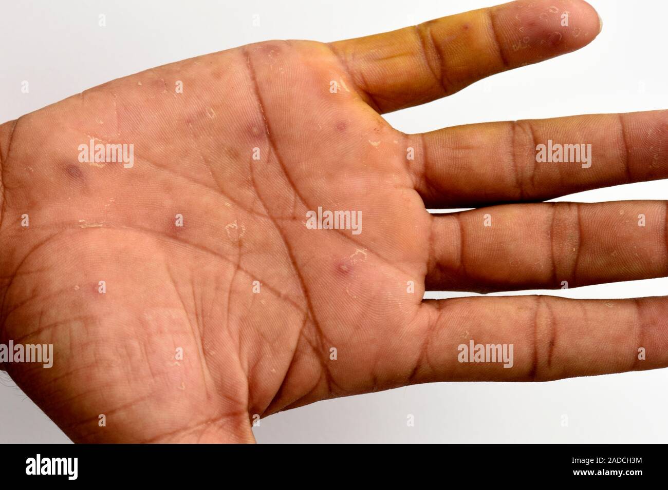 Not for use in Television Not for use in Television Chickenpox in adult ...