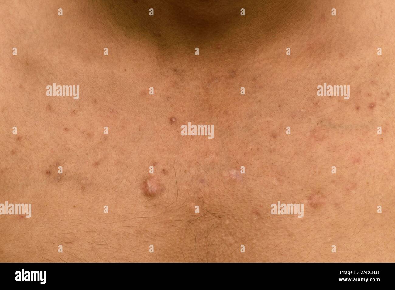 Not for use in Television Not for use in Television Cystic lesions in ...