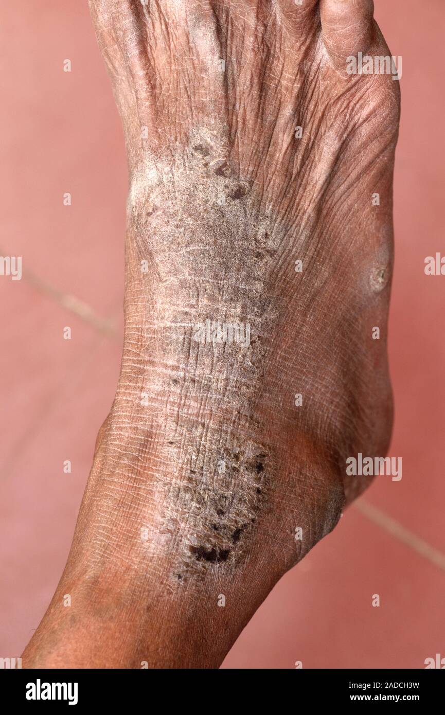 Not for use in Television Not for use in Television Lichenification in ...